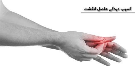 خشک کردن مفصل انگشت دست فوق تخصص جراحی دست روزبه تقوی