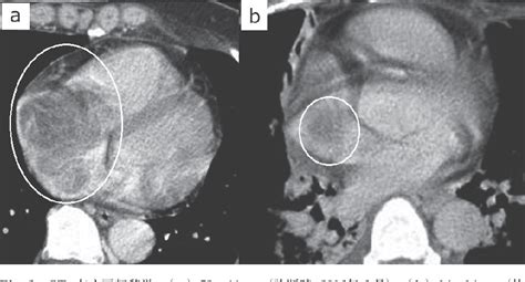 Figure 1 From Radiotherapy Was Effective For Multiple Organ Metastases