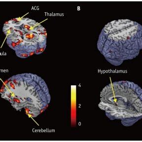 Brain Centers Associated With Visual Sexual Arousal In Humans Download Scientific Diagram