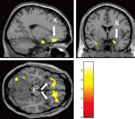 Insular Cortex Fmri