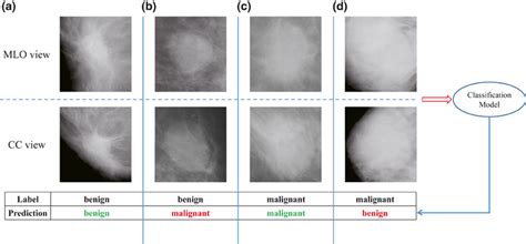 Correct Classification And Misclassification Of Breast Masses A And Download Scientific