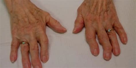 Diagnosing And Managing Hand Osteoarthritis