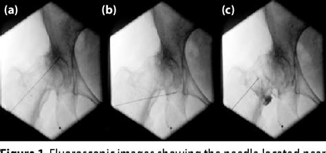 Figure 1 From Fluoroscopy Guided Triple Hip Block For Patients With Hip Osteoarthritis A New
