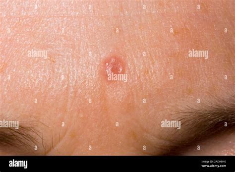 Basal Cell Carcinoma Bcc Or Rodent Ulcer On A 59 Year Old Mans