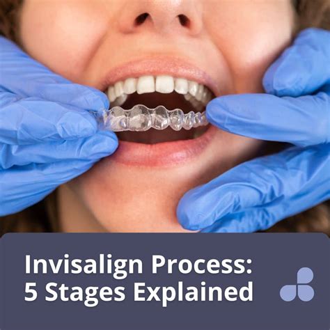 5 Stages Of The Invisalign Treatment Process