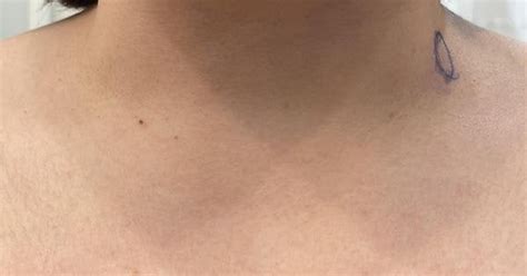 Swollen Subclavicular Lymph Node Raskdocs