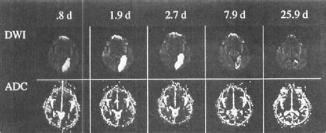 figure 4 from diffusion weighted mri for evaluation of acute stroke semantic scholar