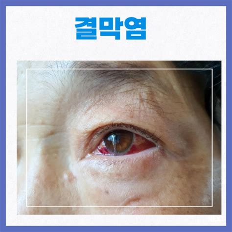 세균성 결막염 증상 원인 알레르기 네이버 블로그