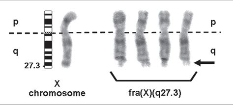 Fragile X Syndrome Karyotype
