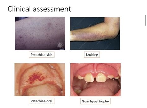 M1 Clinical Approach To The Diagnosis And Classification Of Leukaemia Flashcards Quizlet