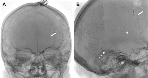 Middle Meningeal Artery Embolization For Management Of Chronic Subdural