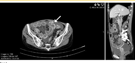 Figure 1 From The Role Of Enterolysis And Tamoxifen In Encapsulating Peritoneal Sclerosis A