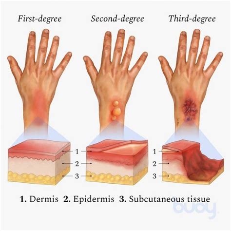The 3 Types Of Burns First Degree Second Degree Third Degree Daily Infographic Types Of