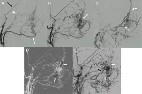Figure 1 From A Case Of Scalp Arteriovenous Malformation Treated By Transvenous Embolization