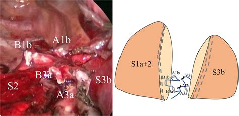 Thoracoscopic “cut‐through” Segmentectomy For Small‐sized Lung Cancer