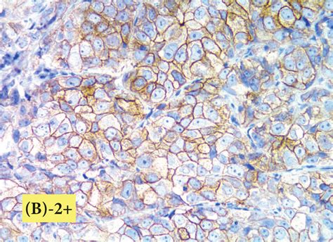 B Shows The Different Staining Patterns That May Be Seen In Her2 Download Scientific Diagram