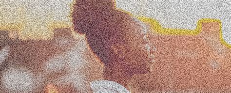 Millions See The World Through A Static Haze Called Visual Snow