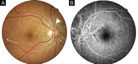 Diagnosis Of Pseudoxanthoma Elasticum In A Patient With Discrete Skin Lesions Anais