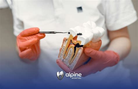 Is Pulling A Tooth Cheaper Than Root Canal Alpine Dental