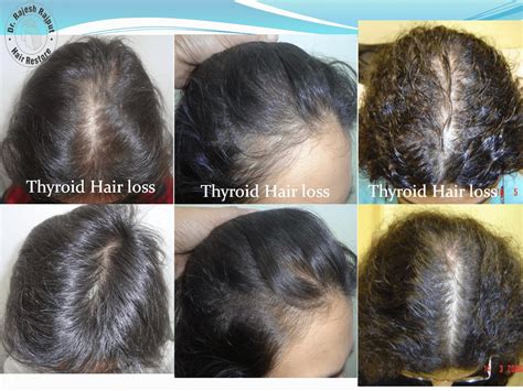 Thyroid 01 Hairlossindia