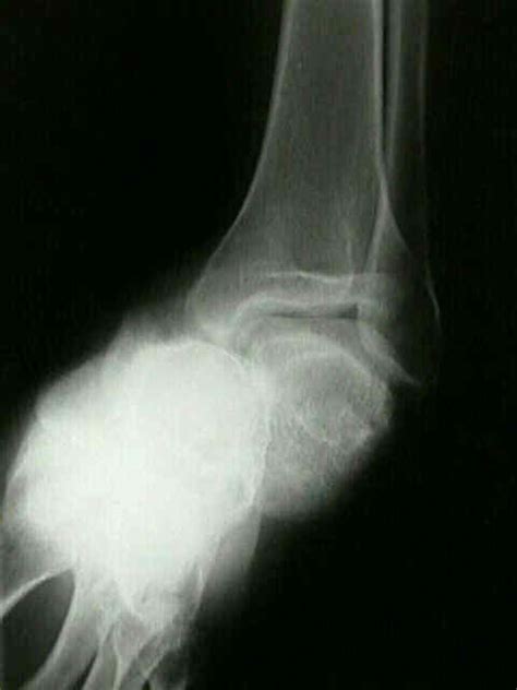 Sub Talar Dislocation Wheeless Textbook Of Orthopaedics