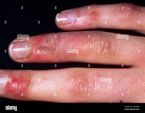 Chilblains Chilblains On The Fingers Of A 16 Year Old Girl Chilblains Are Itchy Red Swellings