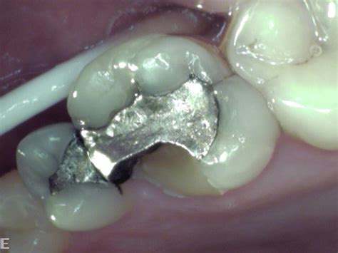 Fractured Cusp Molar