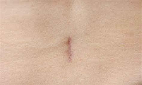 Preventing And Managing Keloid Formation In Surgical Patients Ark