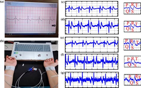 A Picture Of The Real Time Ecg Signal Curve Monitored By The Pc Download Scientific Diagram