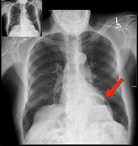 Sliding Hiatal Hernia X Ray At Carmen Pitt Blog
