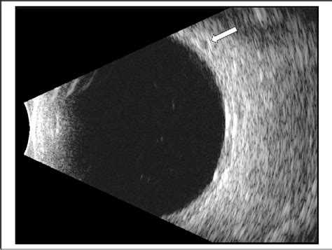 Episcleral Nodule