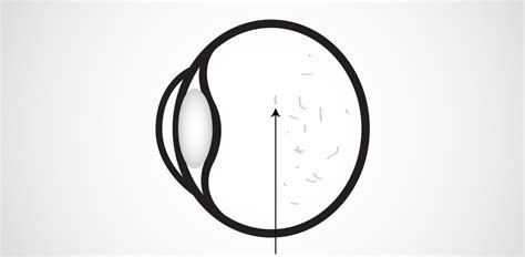 Floater Stories Help Id Vitrectomy Candidates Conexiant