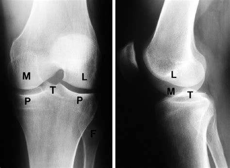 Applied Anatomy Of Knee Joint Epomedicine