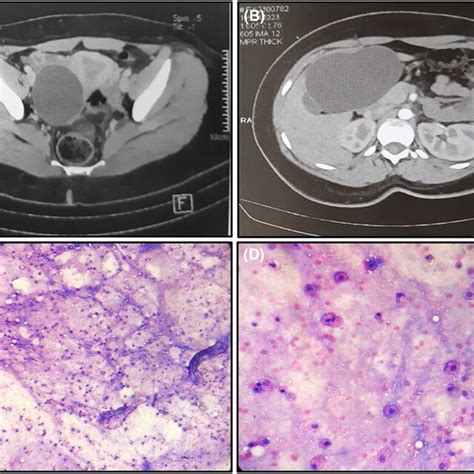 A Multiloculated Hepatic Cyst Lined By Columnar Epithelial Cells Download Scientific Diagram