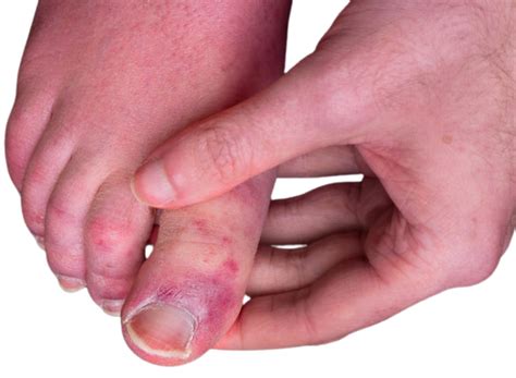 Chilblains Greg Robinson And Ibraheem Podiatry
