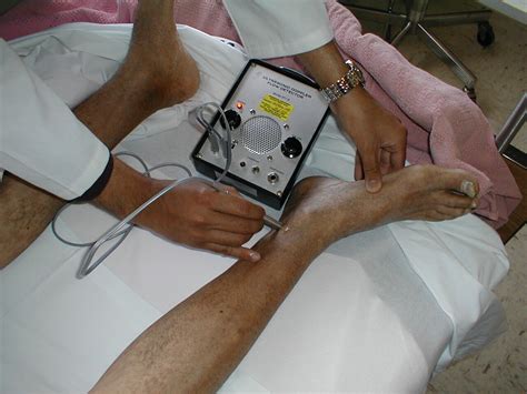 Doppler To Check Pedal Pulses At Robert Thaler Blog