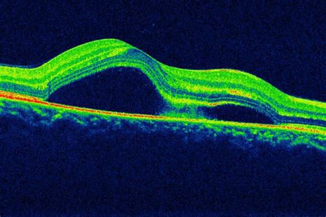 Τι είναι η Κεντρική Ορώδης Χοριοαμφιβληστροειδοπάθεια CSCR Βλάσης Σαφαρίκας Χειρουργός