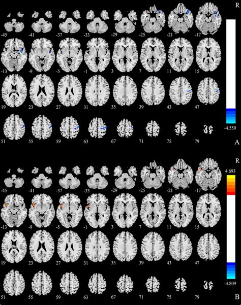 Vbm And Dbm Analysis Of The Gmv A Vbm Analysis Revealed