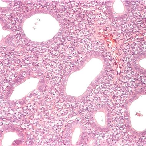 Complex Endometrial Hyperplasia Without Atypia Periglandular