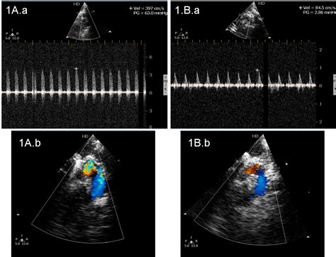 Ascending Aortic Constriction In Rats For Creation Of Pressure Overload