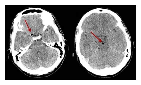 Cranial Ct Scan Showing Pneumocephalus Download Scientific Diagram