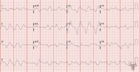 Hyperkalemia Ecg Stampede