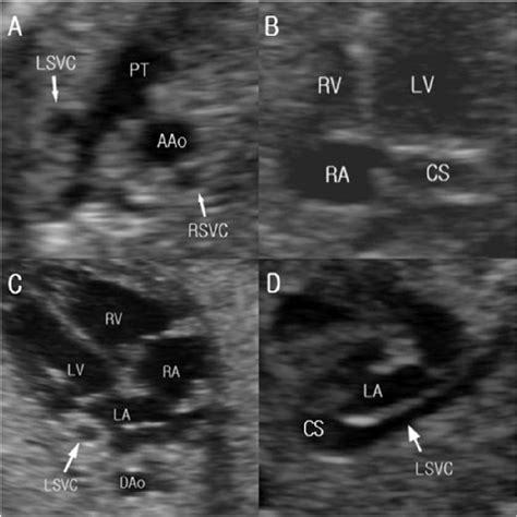 Abnormal Three Vessel View Showing The Persistent Left Superior Vena Download Scientific