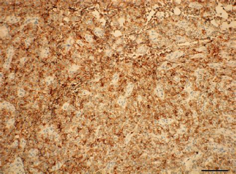 Figure 1 From Primary Malignant Neuroectodermal Tumor Of The Ileum With