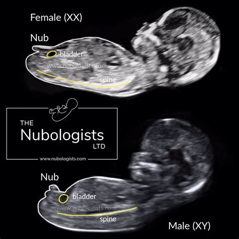 The Nub Theory Nub Theory Ultrasound Gender Prediction Gender