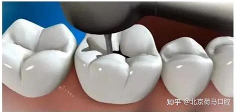 蛀牙了一定要拔吗？浅龋、中龋、深龋如何治疗？ 知乎