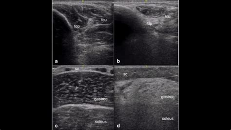 Myositis Internet Book Of Msk Ultrasound