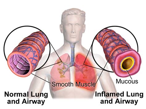 What Is Asthma