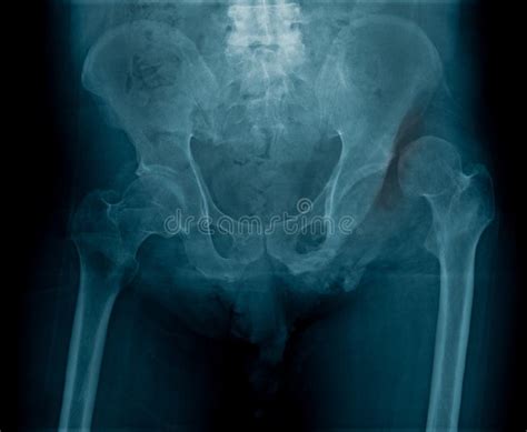 Dislocation Of Left Hip Joint Stock Image Image Of Patient Anatomy 130883107