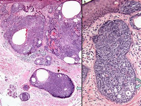 Malignant Adnexal Neoplasms Modern Pathology